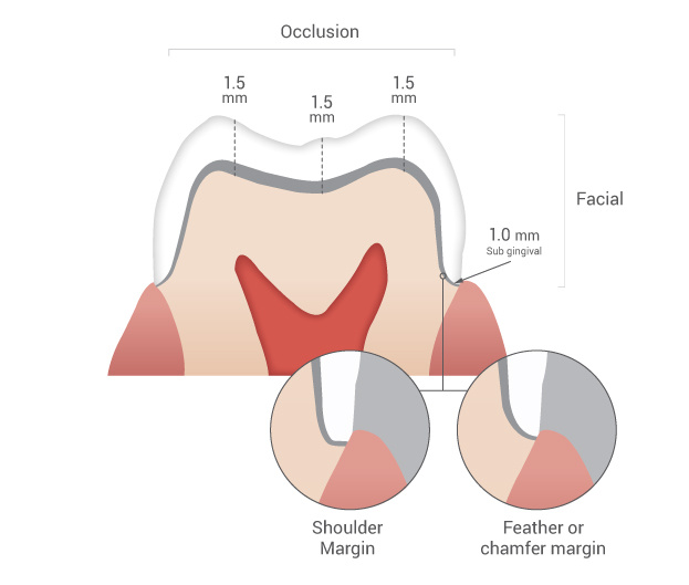 How to prep a tooth for a PFM crown
