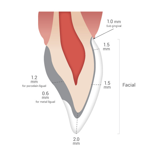 How to prep a tooth for a PFM crown